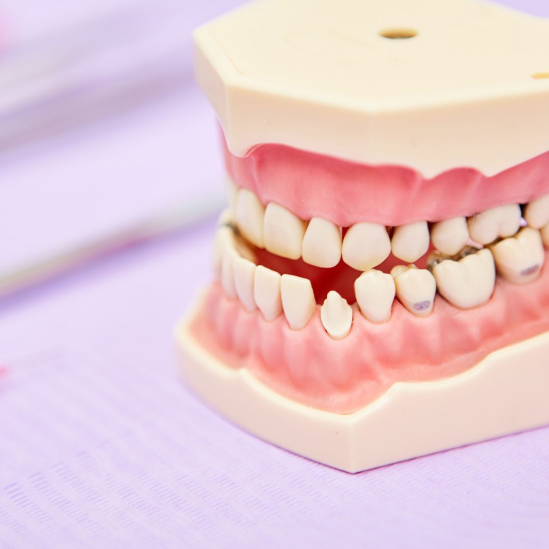 Malocclusione in fisioterapia: perché non è solo un problema dei denti ...